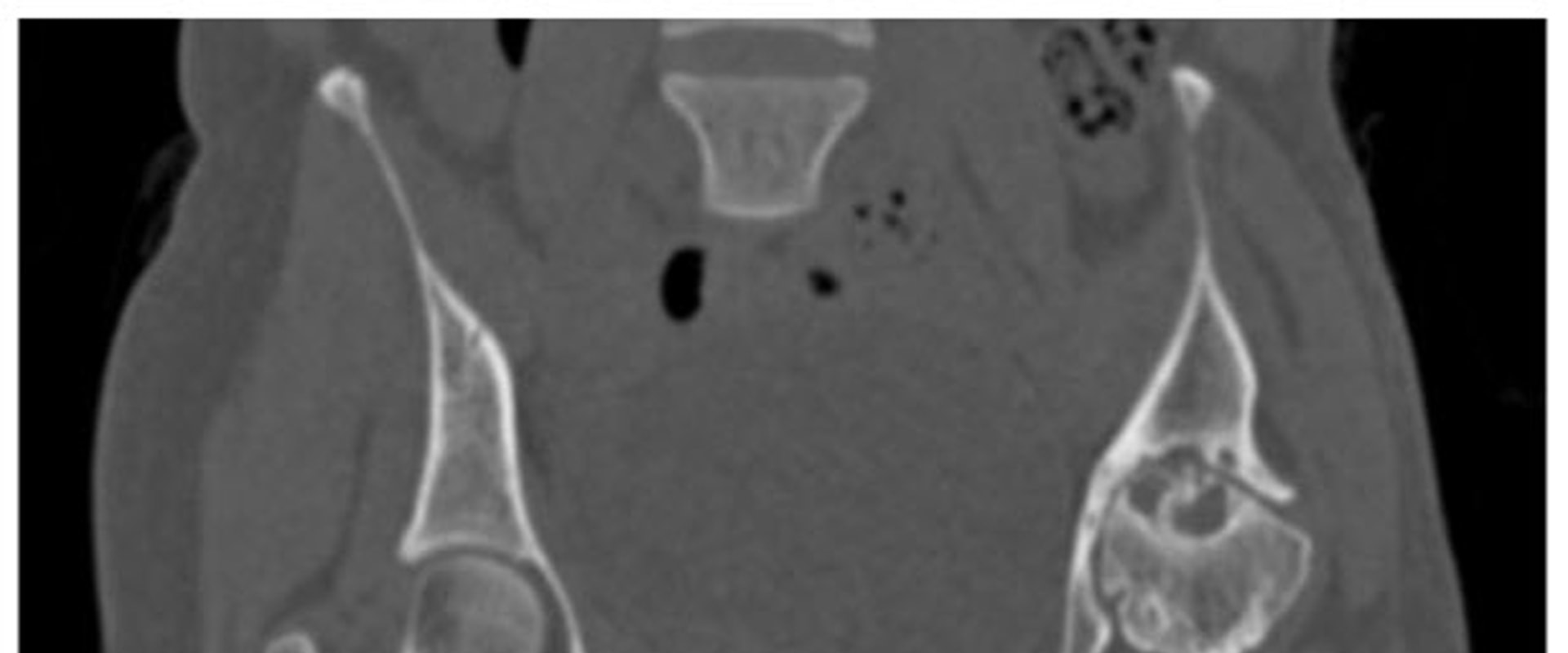 What is an Ion Chamber in Radiology? A Comprehensive Guide